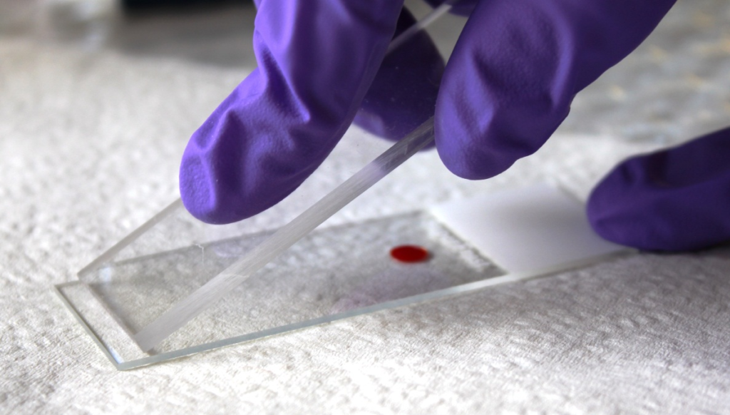 Peripheral Smear Test: Procedure, Preparation, and Aftercare - Health ...